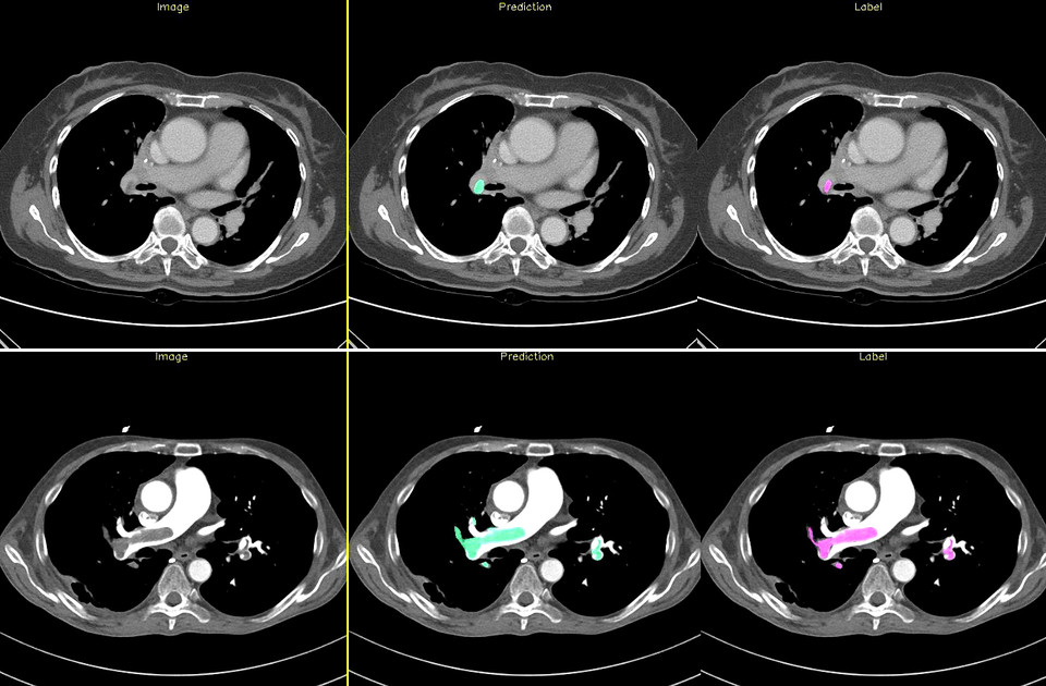 의료AI 기업 모니터코퍼레이션, 폐색전증 검출 딥러닝 알고리즘 연구개발 성과 공개