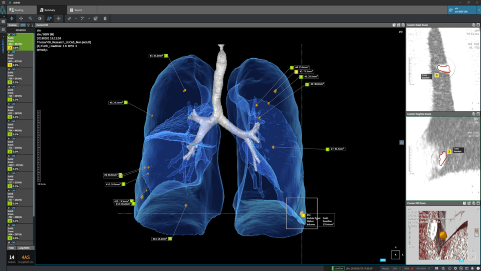 코어라인 의료 AI 솔루션 'AVIEW', 브라질 식약위생감시국 시판전 허가 획득